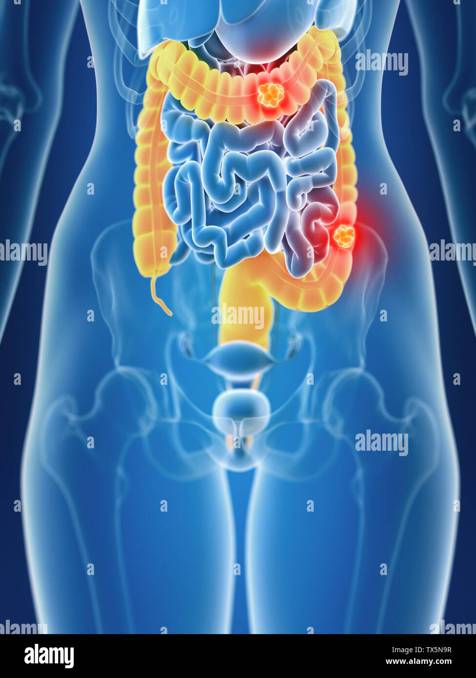 3d rendered medically accurate illustration of a females colon cancer ...