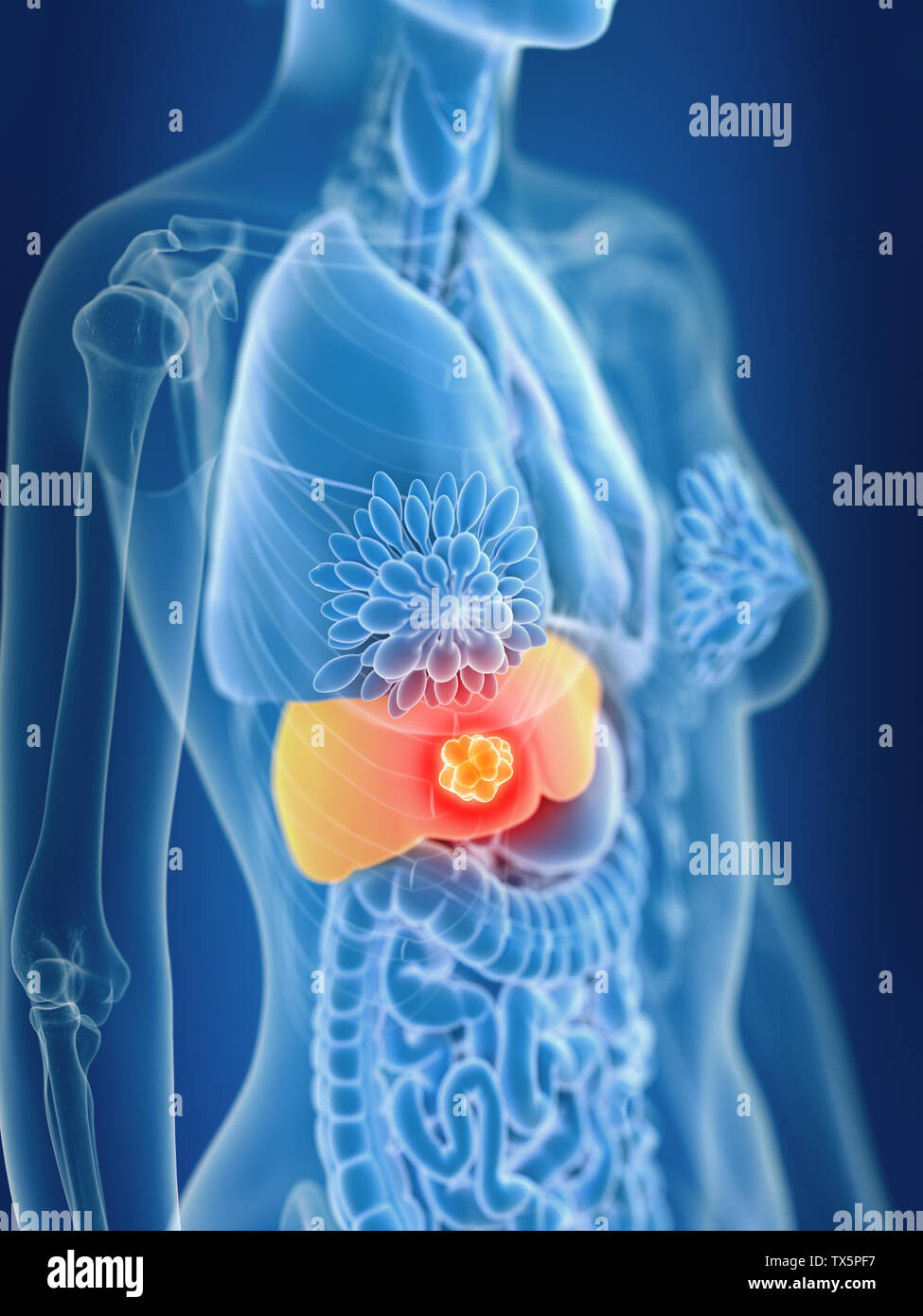 3d rendered medically accurate illustration of a females liver cancer ...