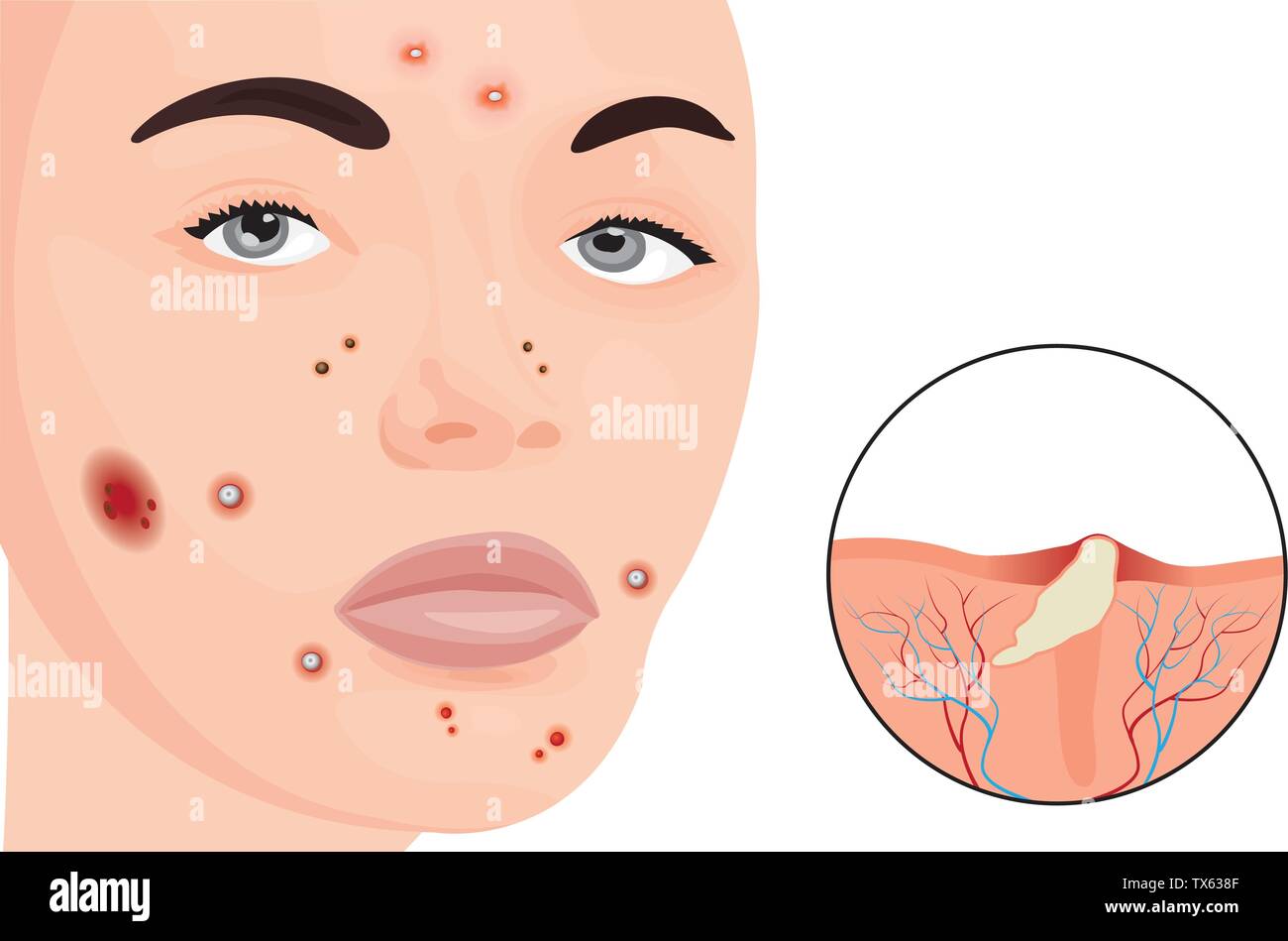 Acne on a woman face vector illustration Stock Vector Image & Art - Alamy