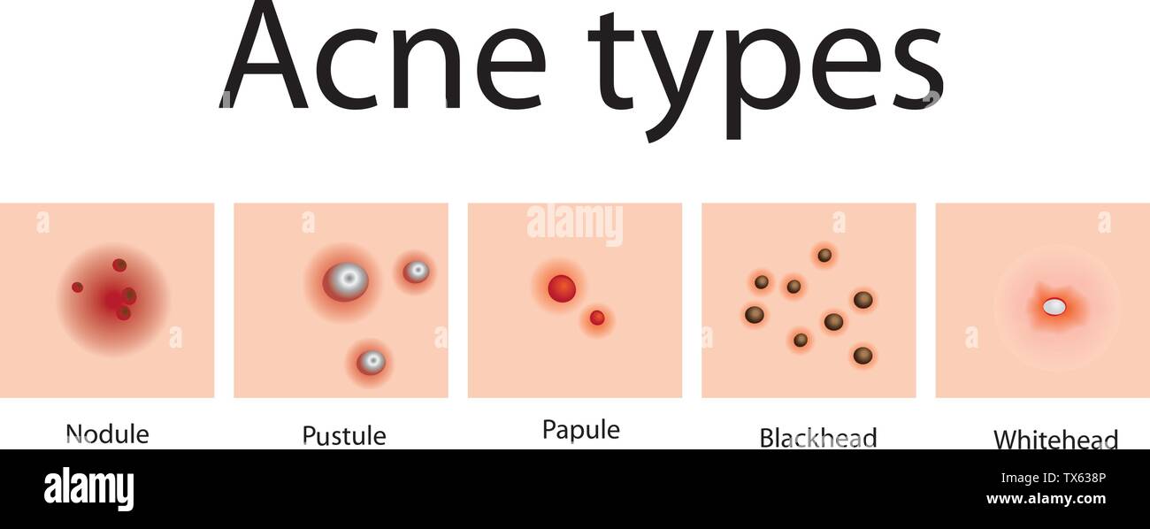 Acne types problem skin dermatology vector illustration Stock Vector ...