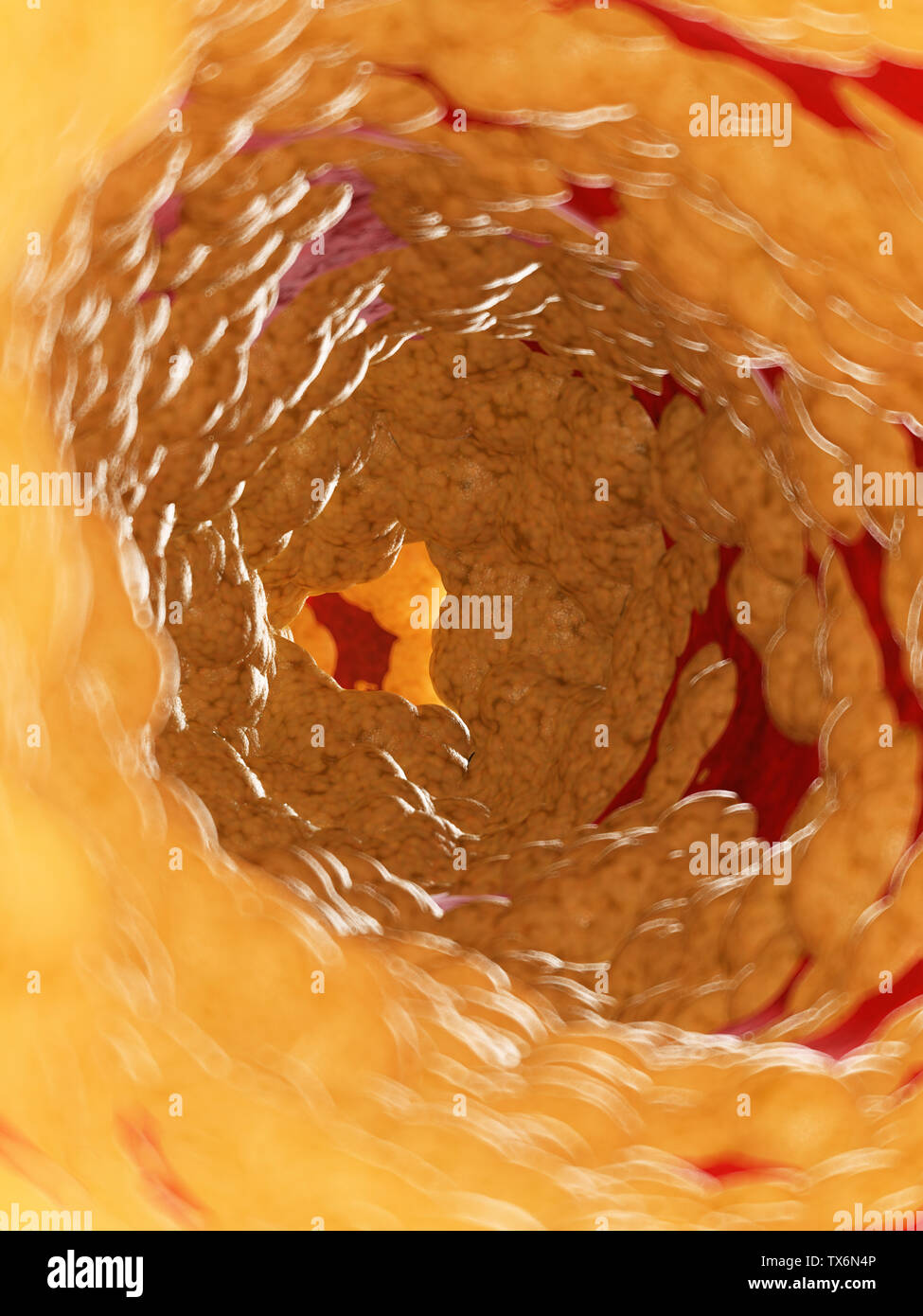 3d rendered medically accurate illustration of fat inside of an artery ...