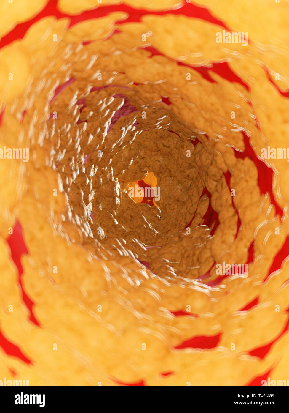 3d rendered medically accurate illustration of fat inside of an artery ...