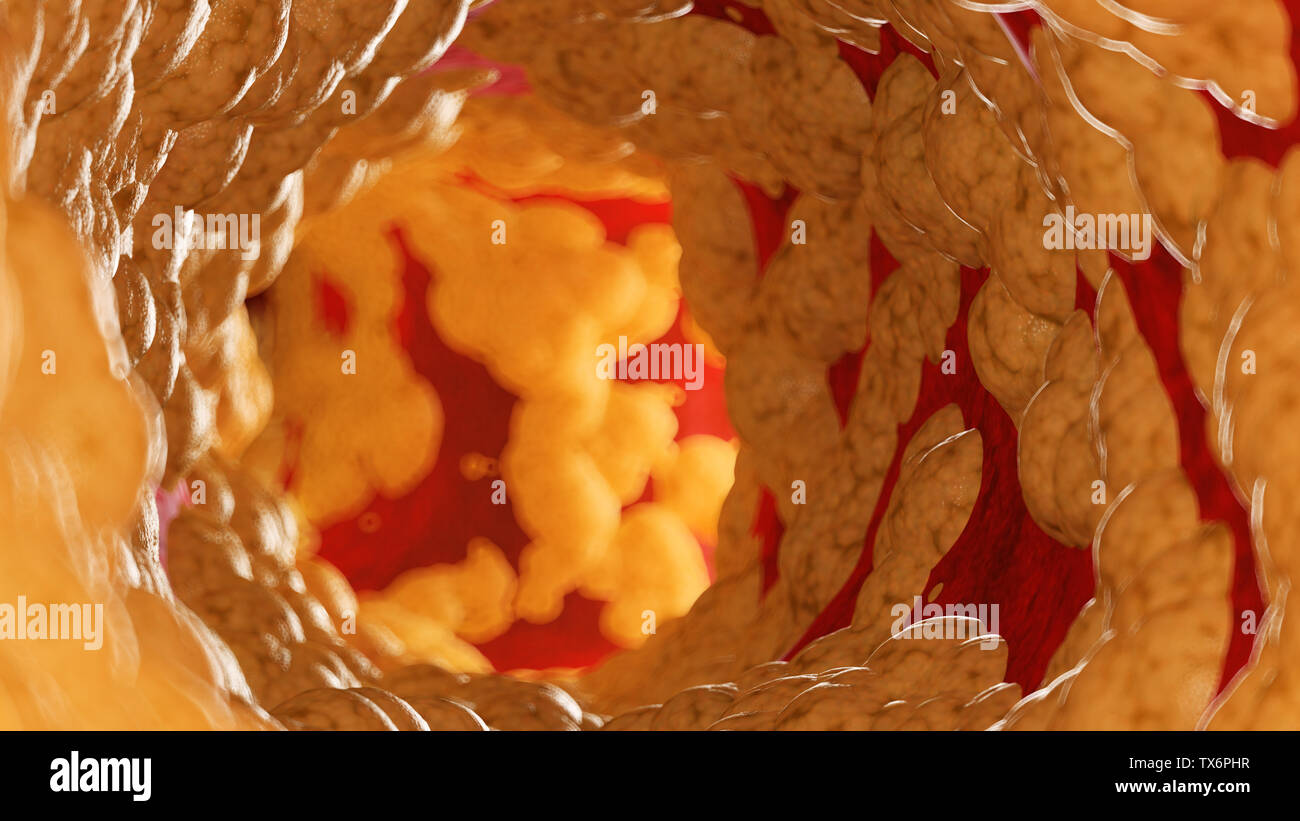 3d rendered medically accurate illustration of fat inside of an artery ...