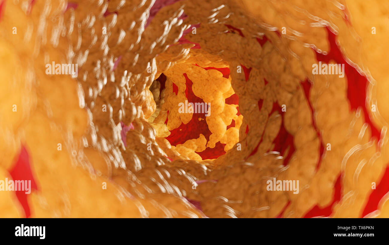 3d rendered medically accurate illustration of fat inside of an artery ...