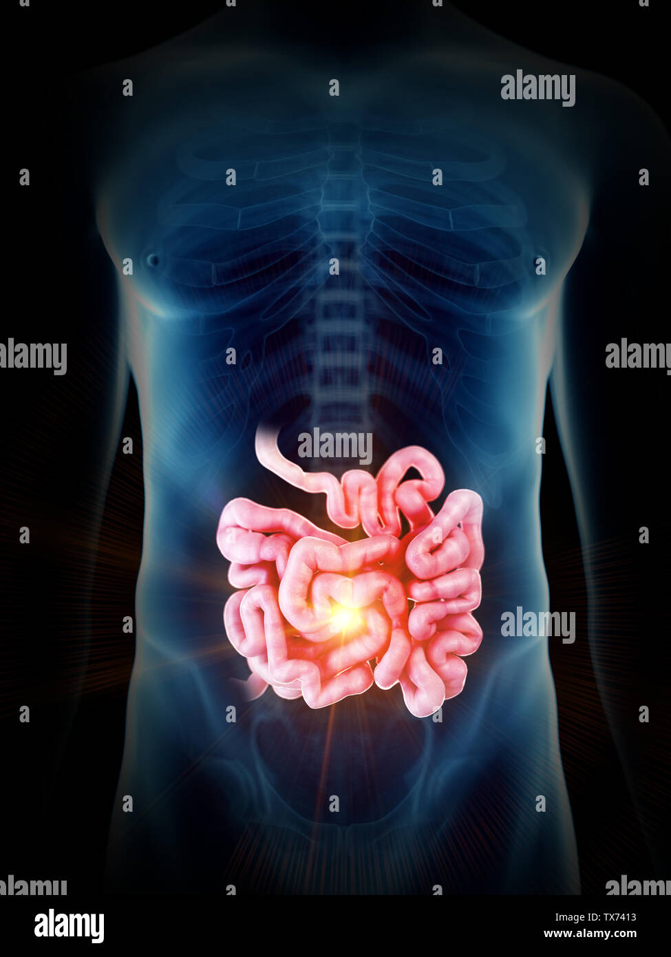 3d rendered medically accurate illustration of a painful small ...