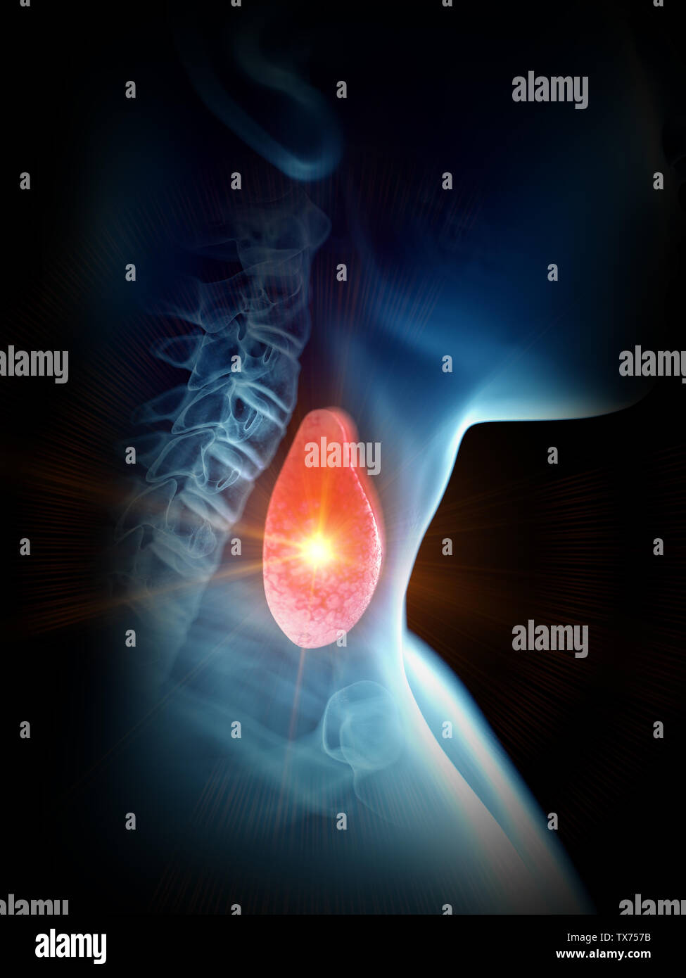 3d rendered medically accurate illustration of a painful thyroid gland ...