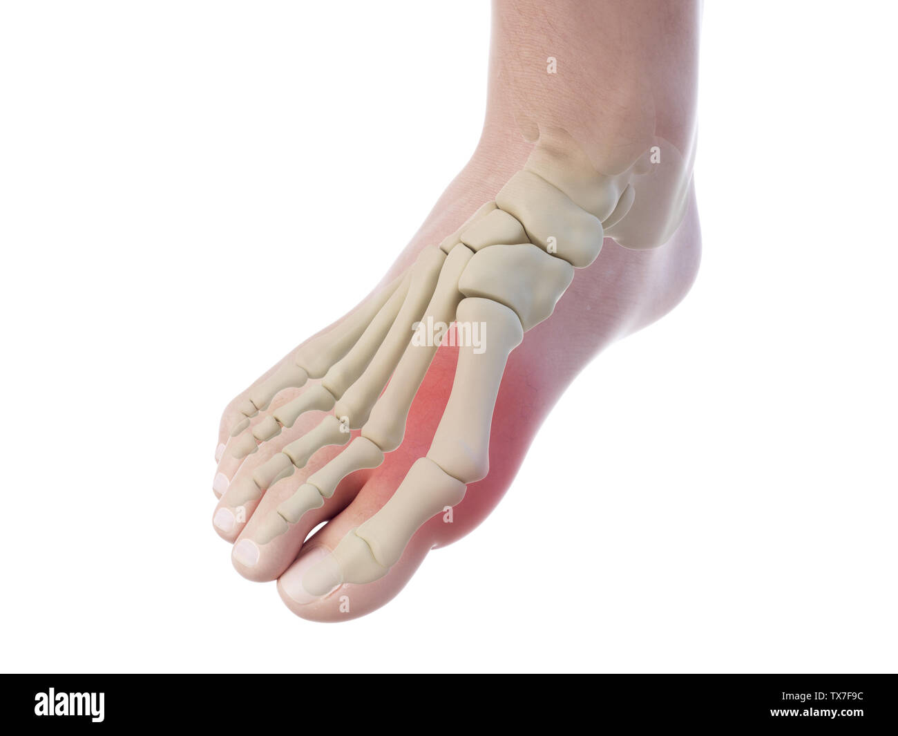 Skeletal deformity hi-res stock photography and images - Alamy