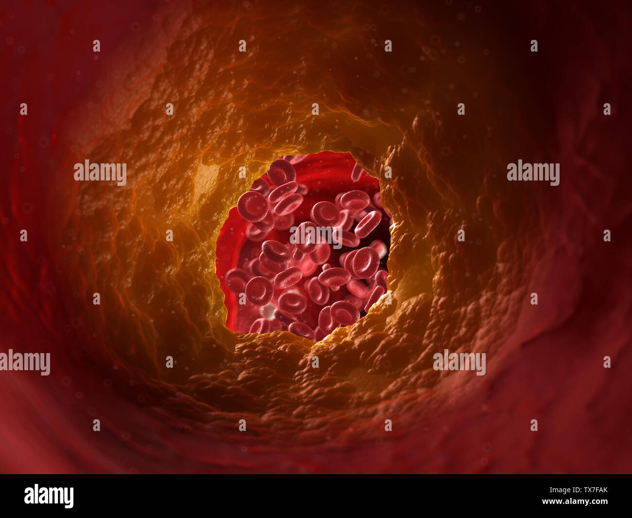 3d rendered medically accurate illustration of a blocked artery Stock ...