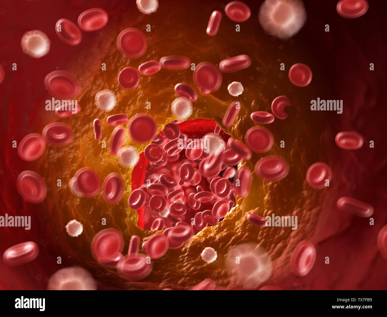 3d rendered medically accurate illustration of a blocked artery Stock ...