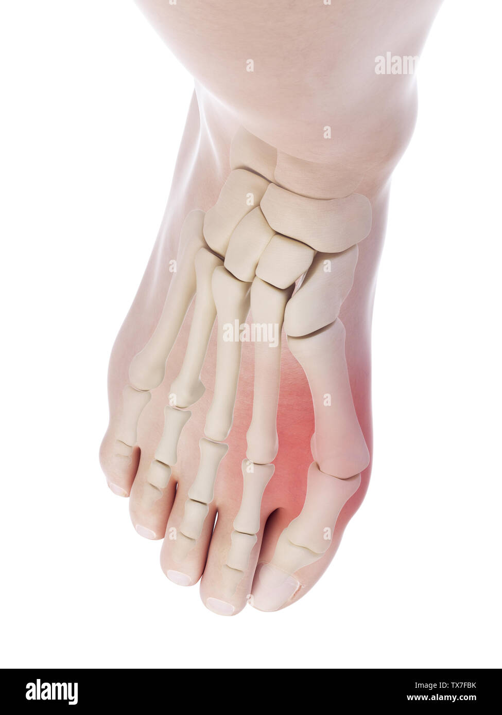 Skeletal deformity hi-res stock photography and images - Alamy