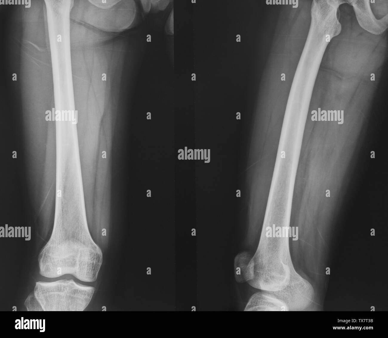 Normal knee x ray hi-res stock photography and images - Alamy
