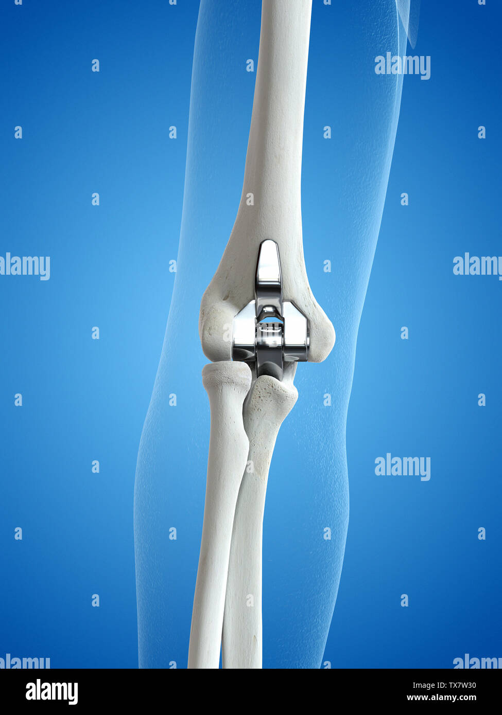 3d rendered medically accurate illustration of an elbow replacement ...