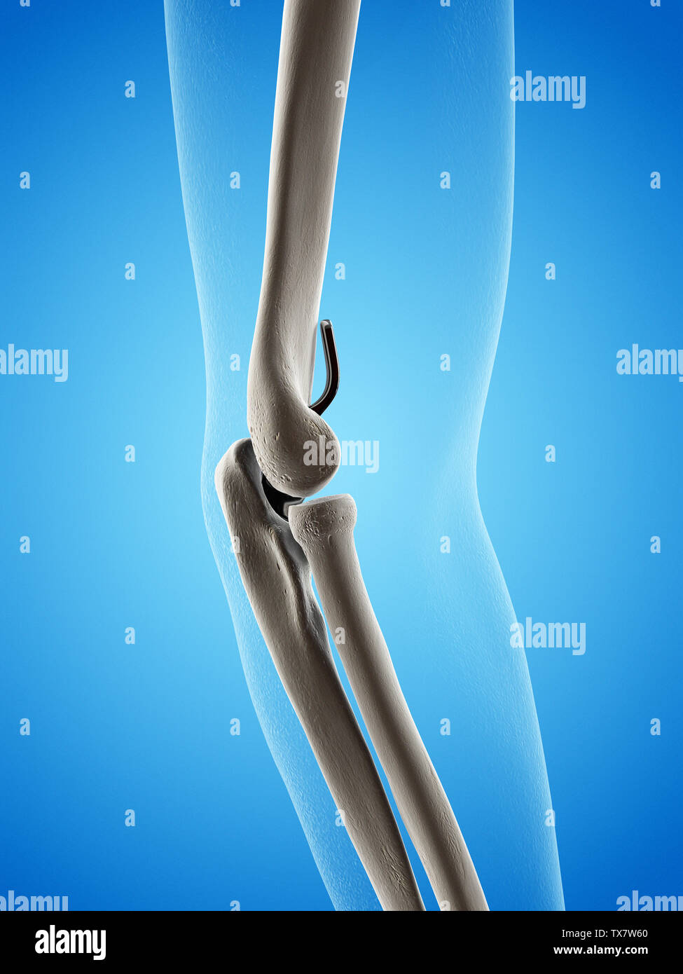 3d rendered medically accurate illustration of an elbow replacement ...