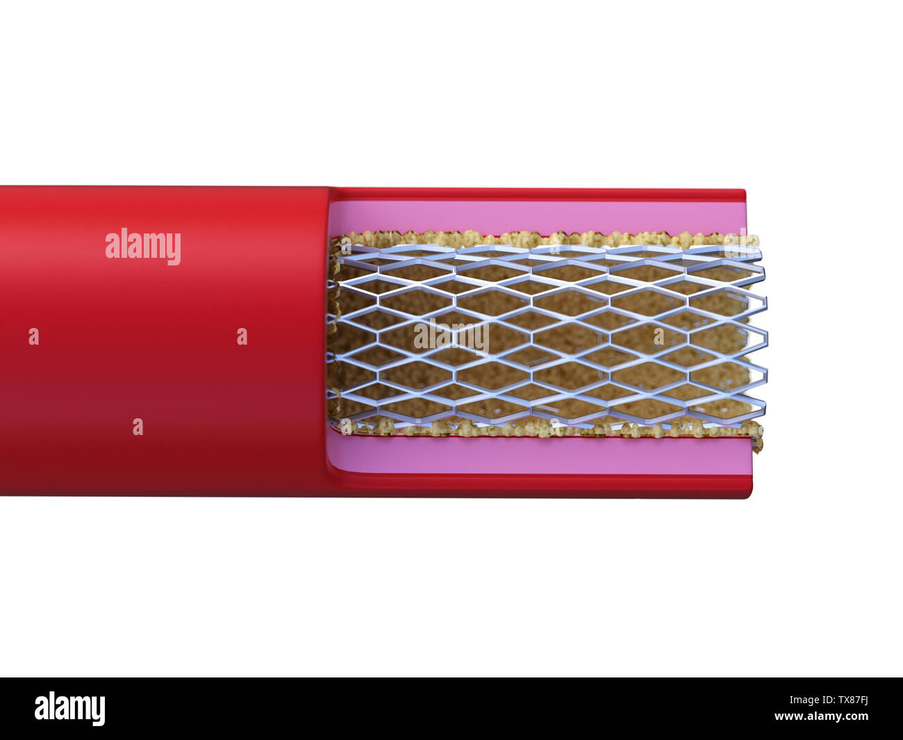 Coronary artery stent hi-res stock photography and images - Alamy