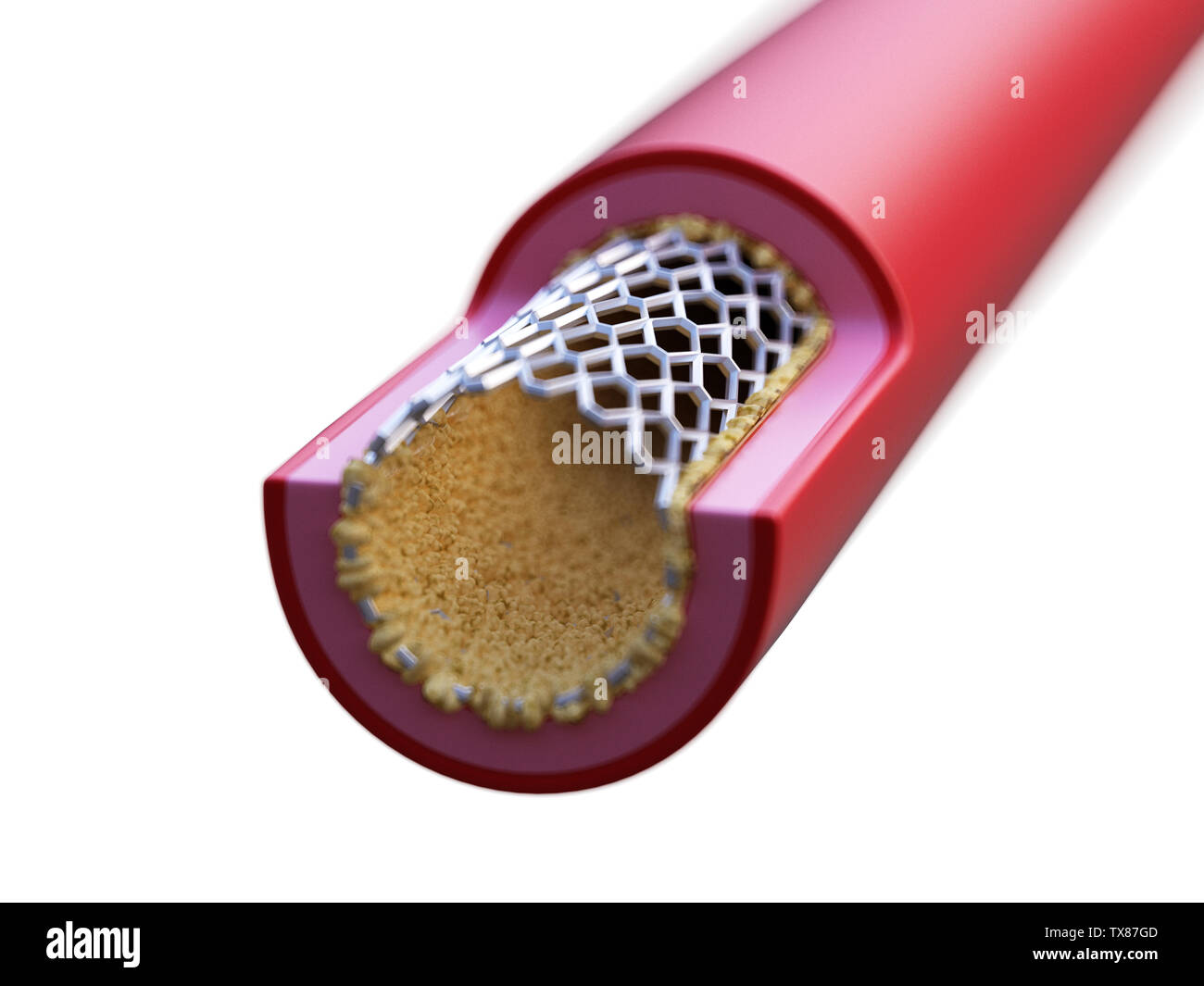 3d rendered medically accurate illustration of a stent in action Stock ...