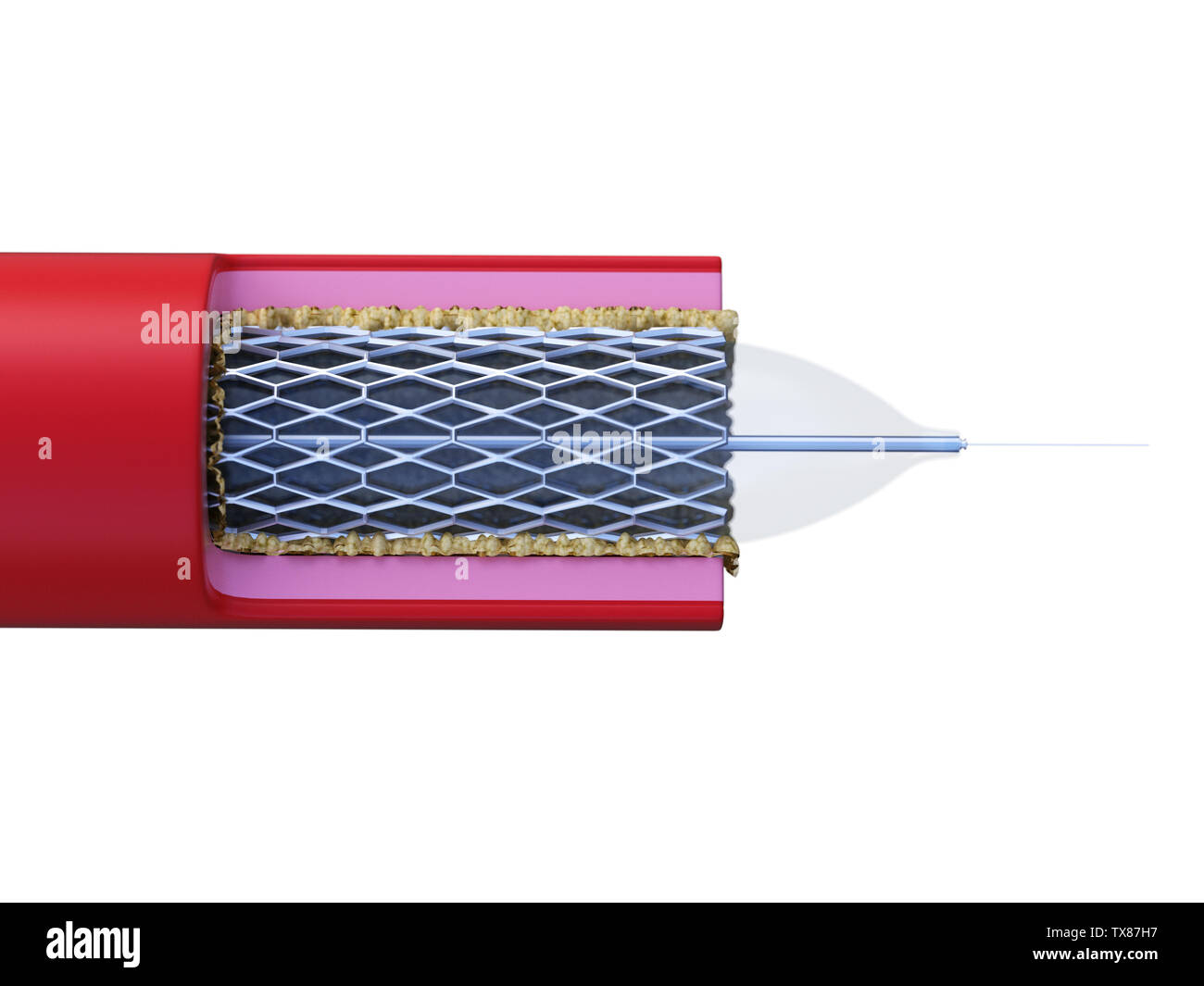 3d rendered medically accurate illustration of stent placed in an ...