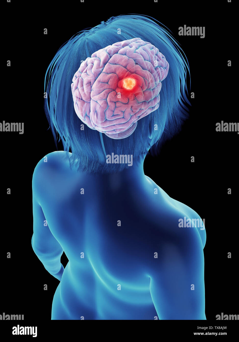 3d rendered medically accurate illustration of a tumor in a womans ...