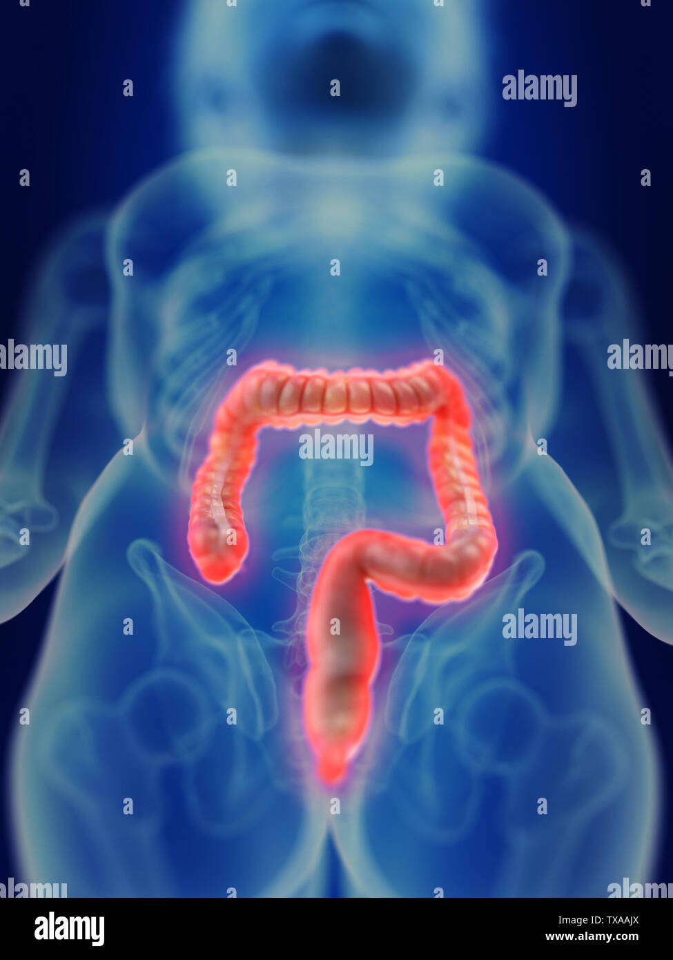 3d rendered medically accurate illustration of an inflamed colon Stock ...