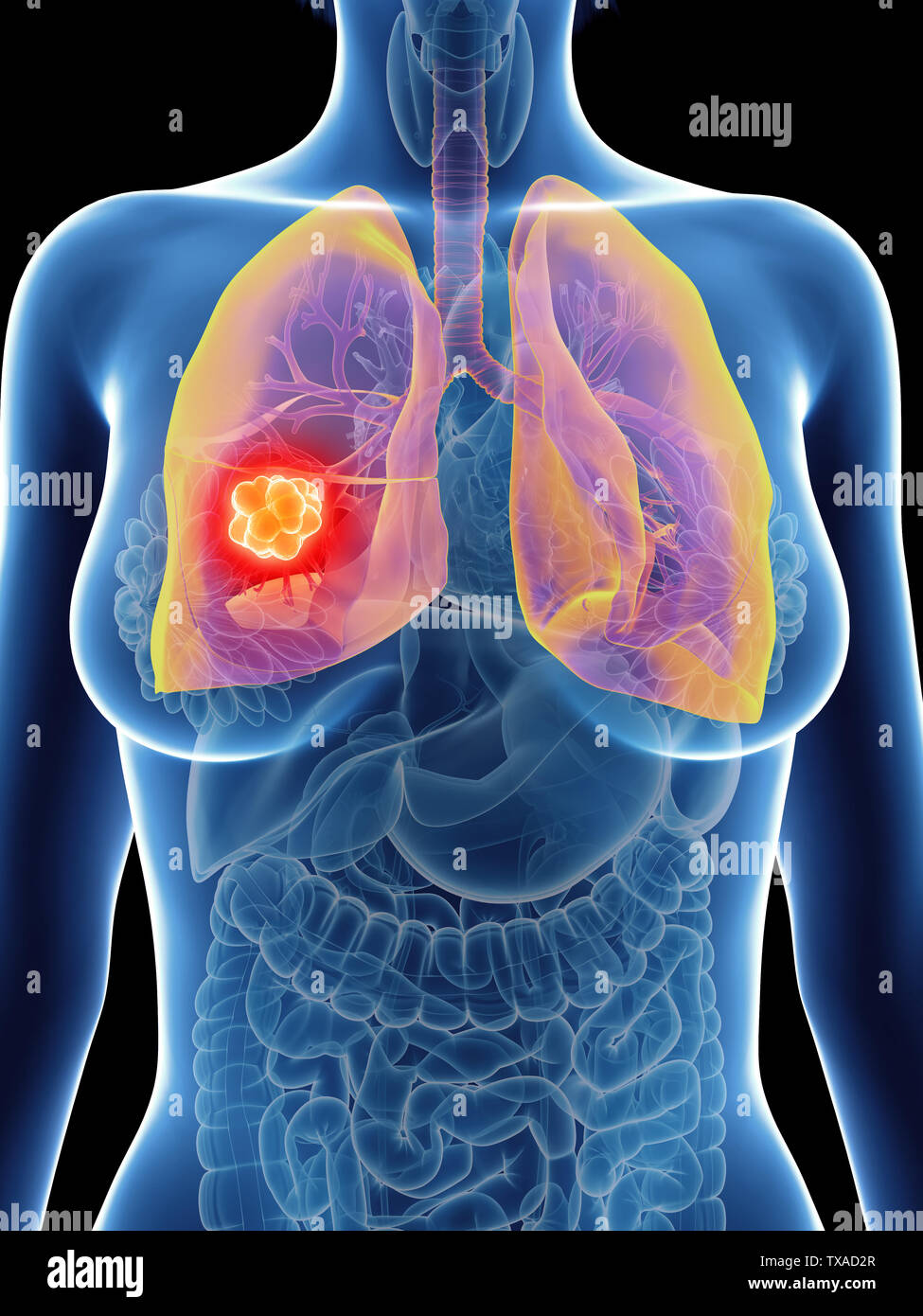 3d rendered medically accurate illustration of a womans lung cancer ...