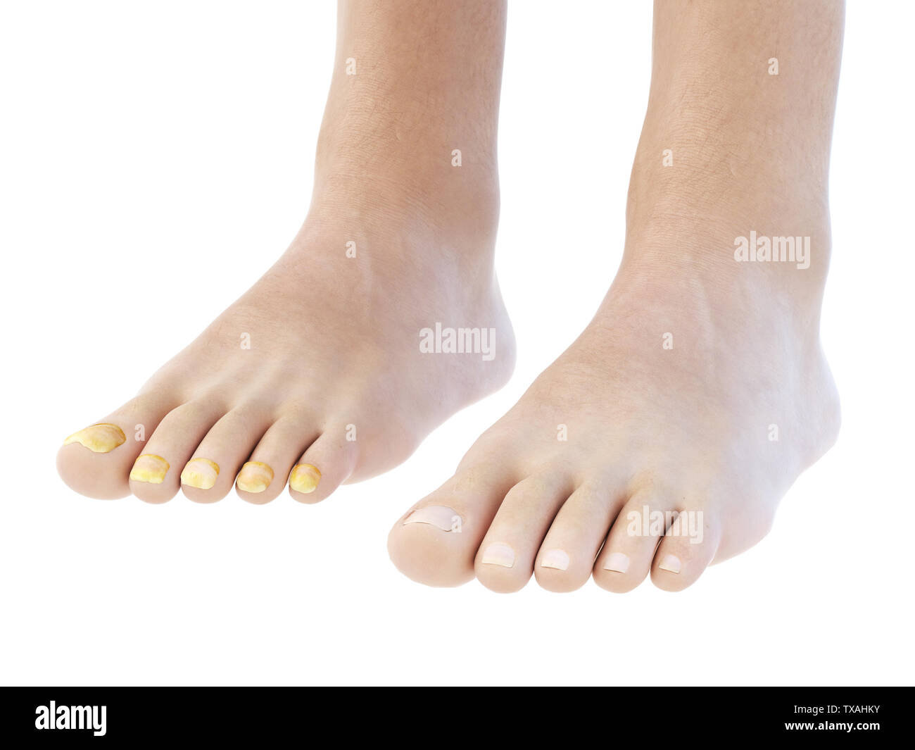 Toe nail fungus hi-res stock photography and images - Alamy