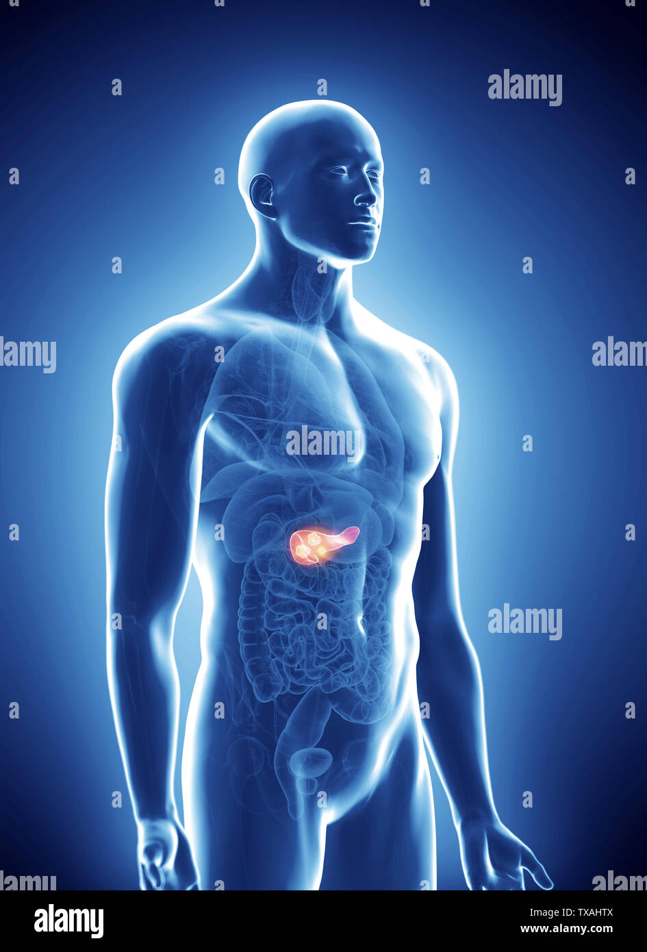 3d rendered, medically accurate illustration of pancreas cancer Stock ...