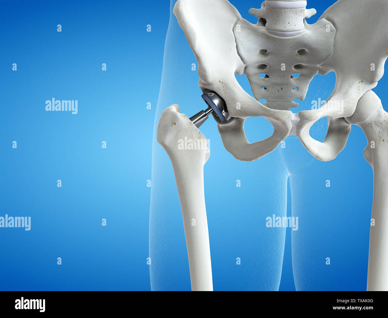 3d rendered medically accurate illustration of a hip replacement Stock ...