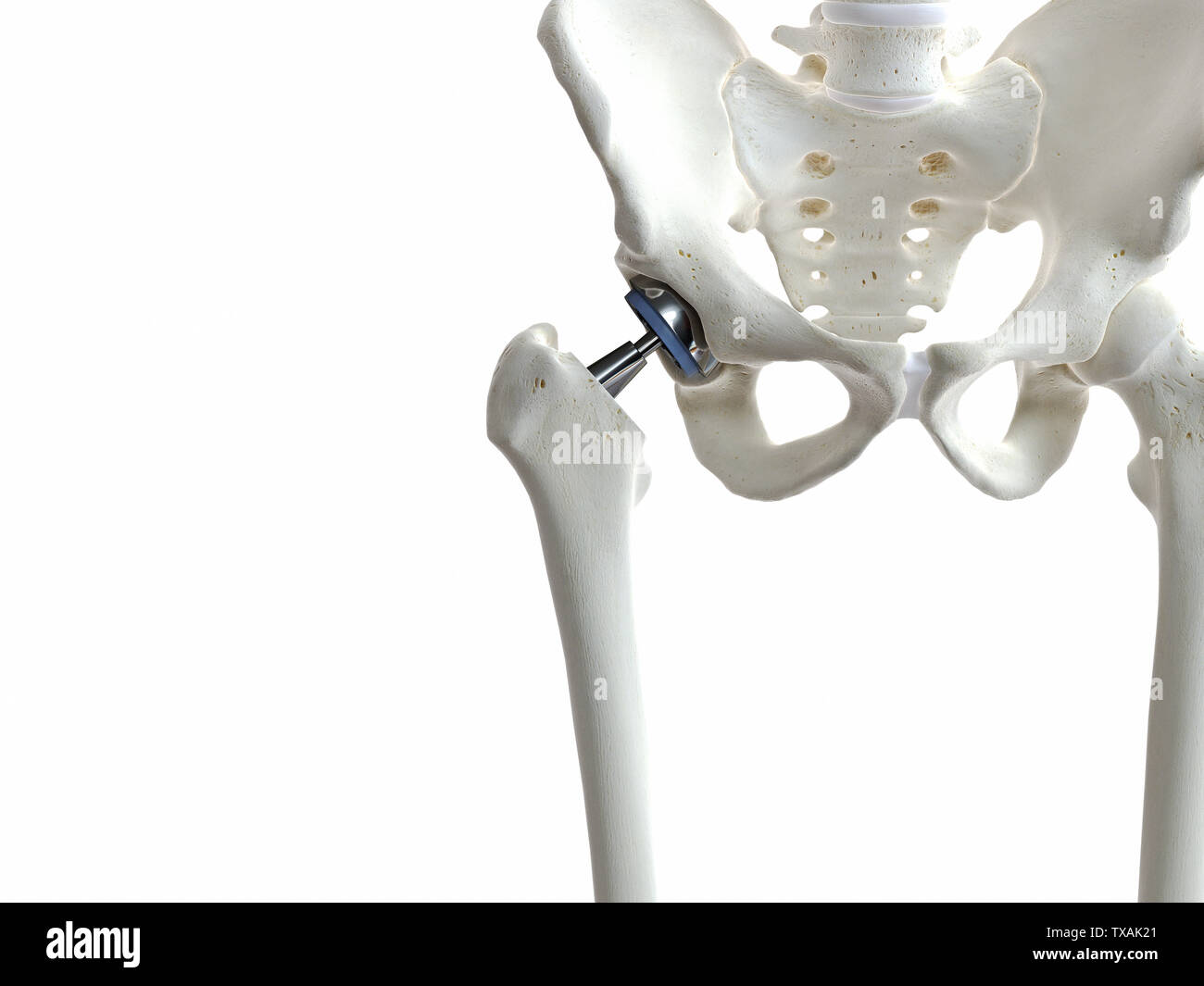 Joint replacement orthopedic titanium hi-res stock photography and ...