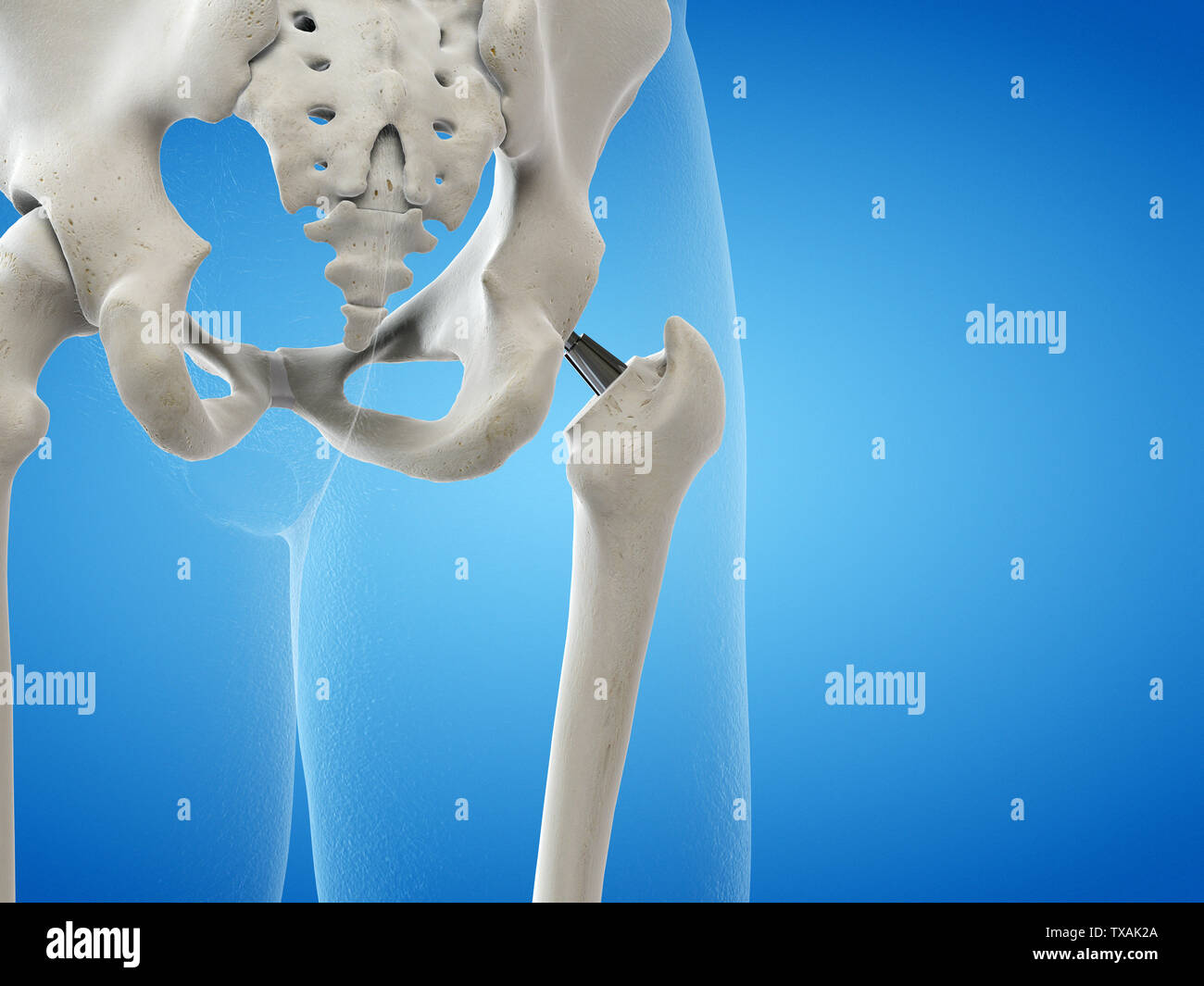 3d rendered medically accurate illustration of a hip replacement Stock ...