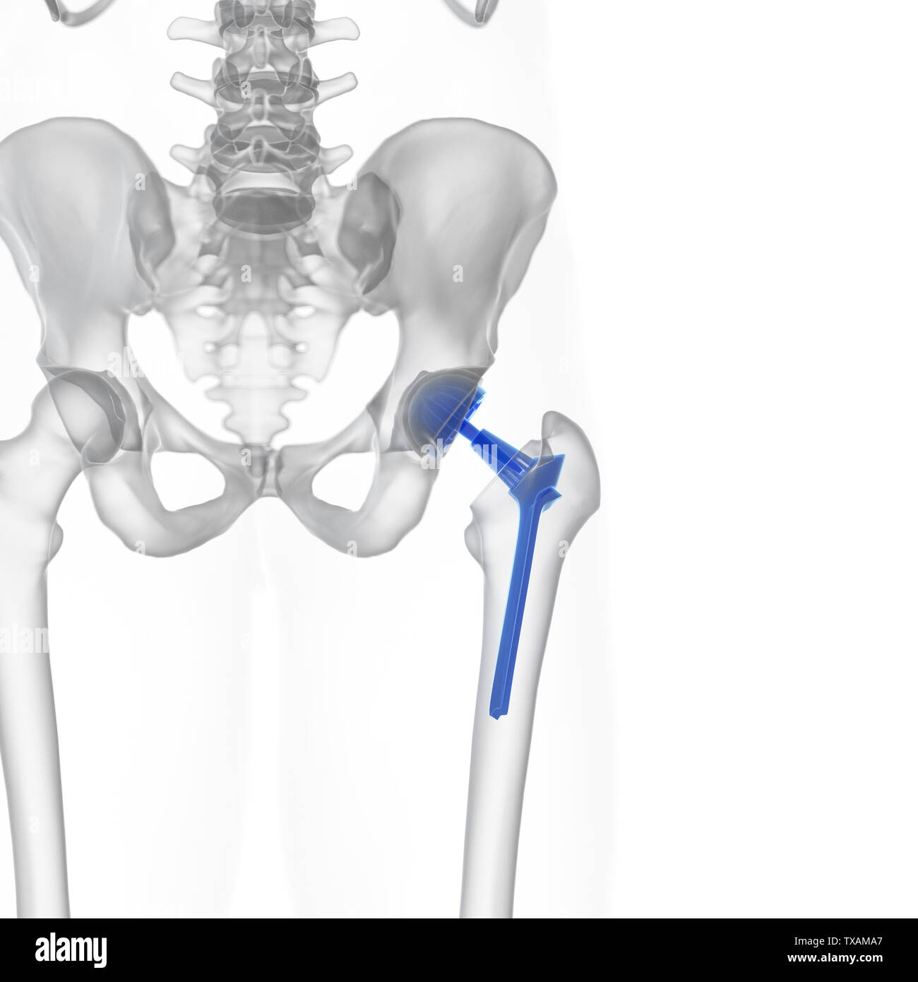 Artificial hip joint xray hi-res stock photography and images - Alamy