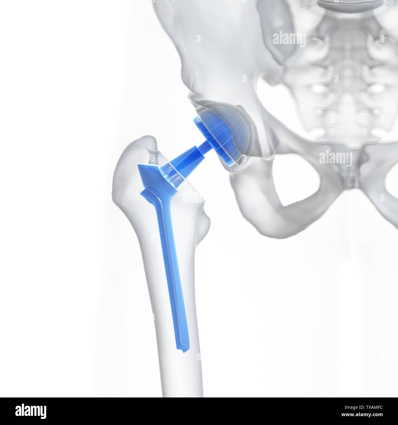 Hip replacement xray hi-res stock photography and images - Alamy