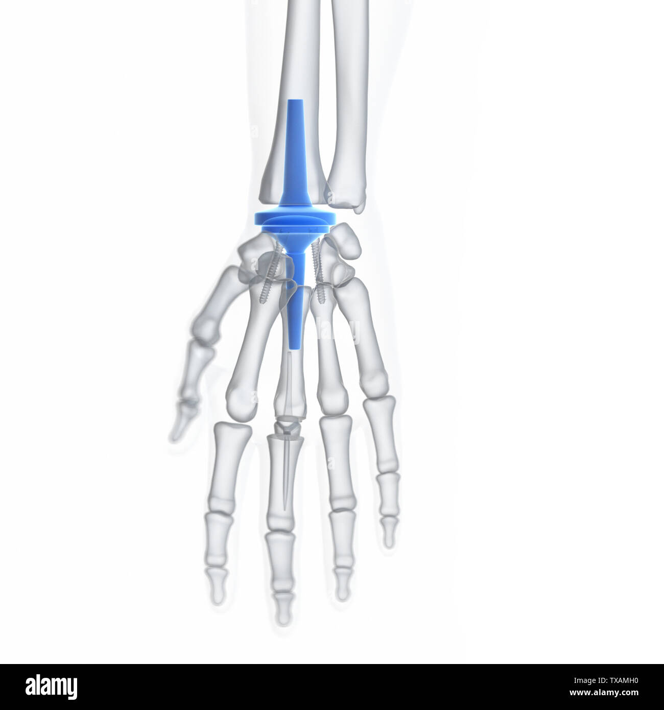 3d rendered medically accurate illustration of a wrist replacement ...