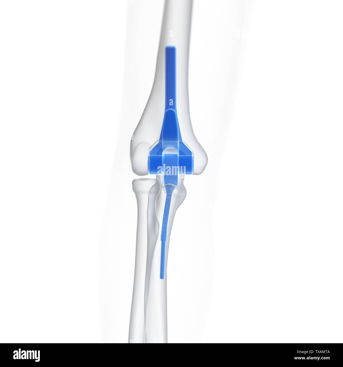 3d rendered medically accurate illustration of an elbow replacement ...
