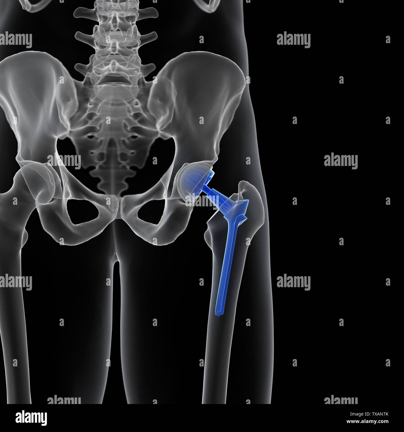 3d rendered medically accurate illustration of a hip replacement Stock ...