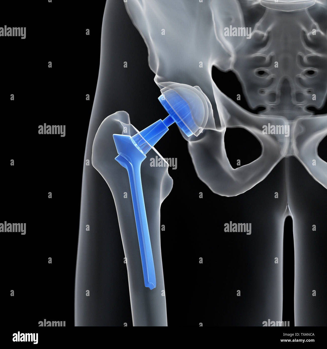3d rendered medically accurate illustration of a hip replacement Stock ...