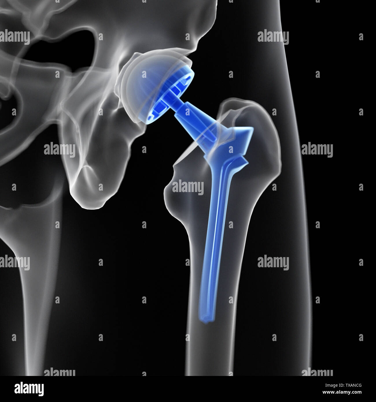 Hip replacement xray hi-res stock photography and images - Alamy