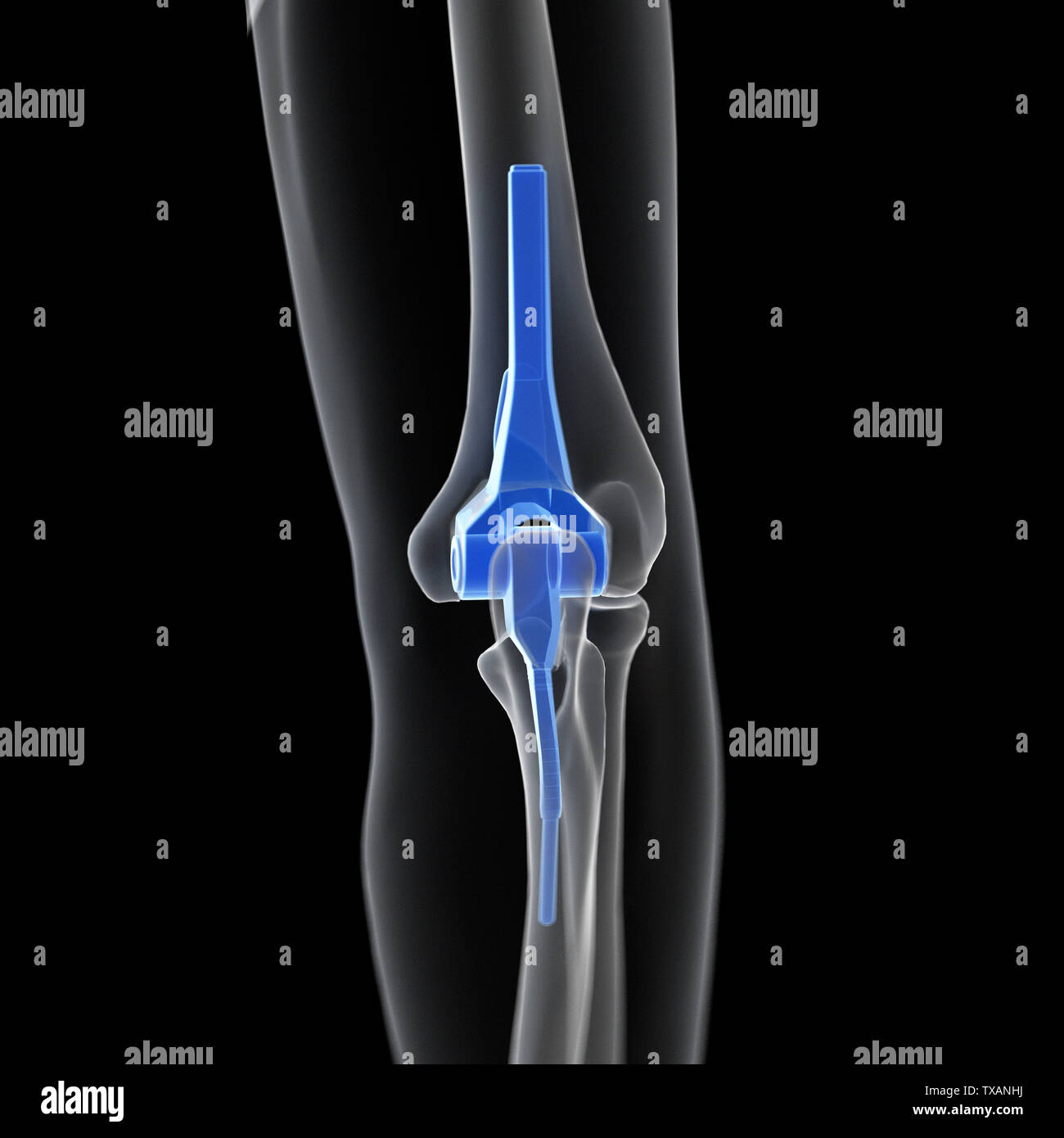 Elbow joint replacement hi-res stock photography and images - Alamy