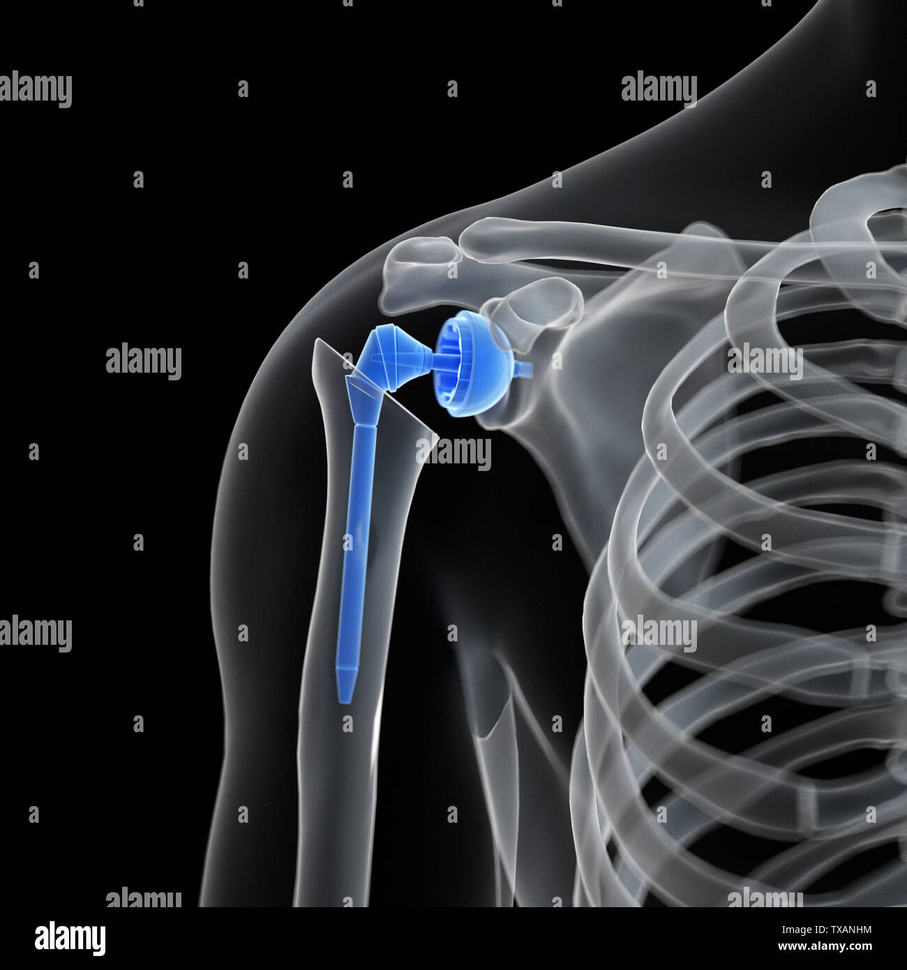 3d rendered medically accurate illustration of a shoulder replacement ...