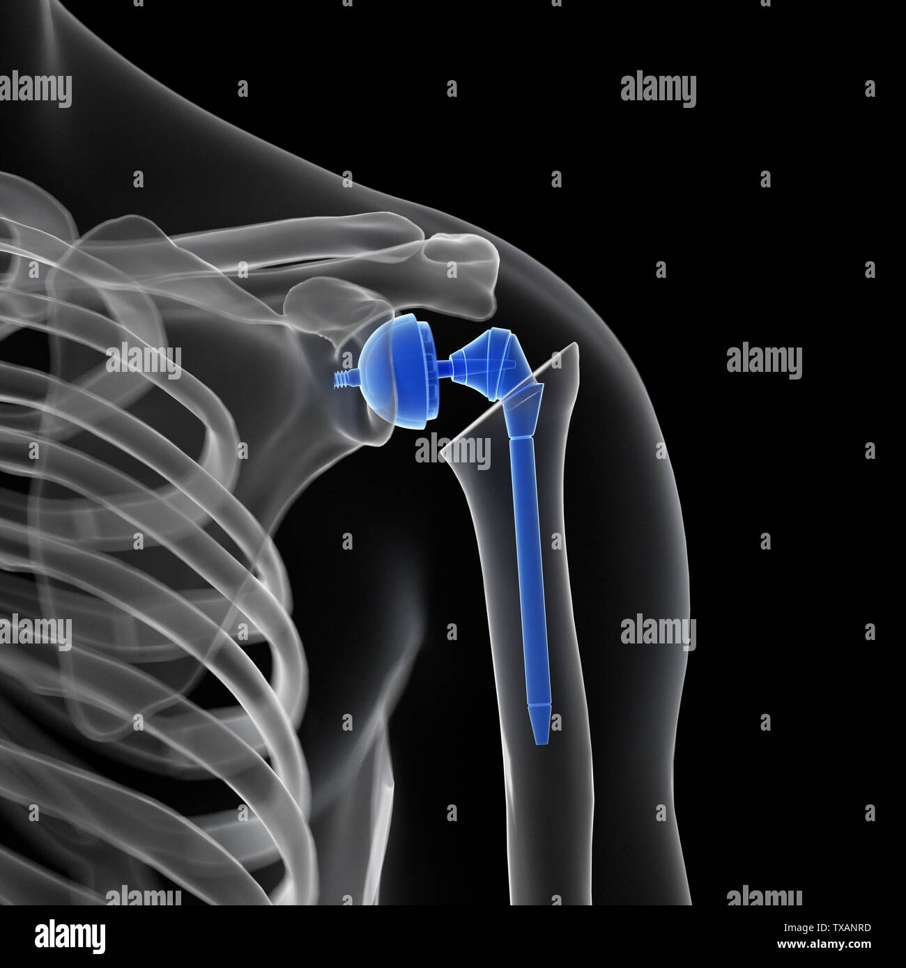 Shoulder joint replacement hi-res stock photography and images - Alamy