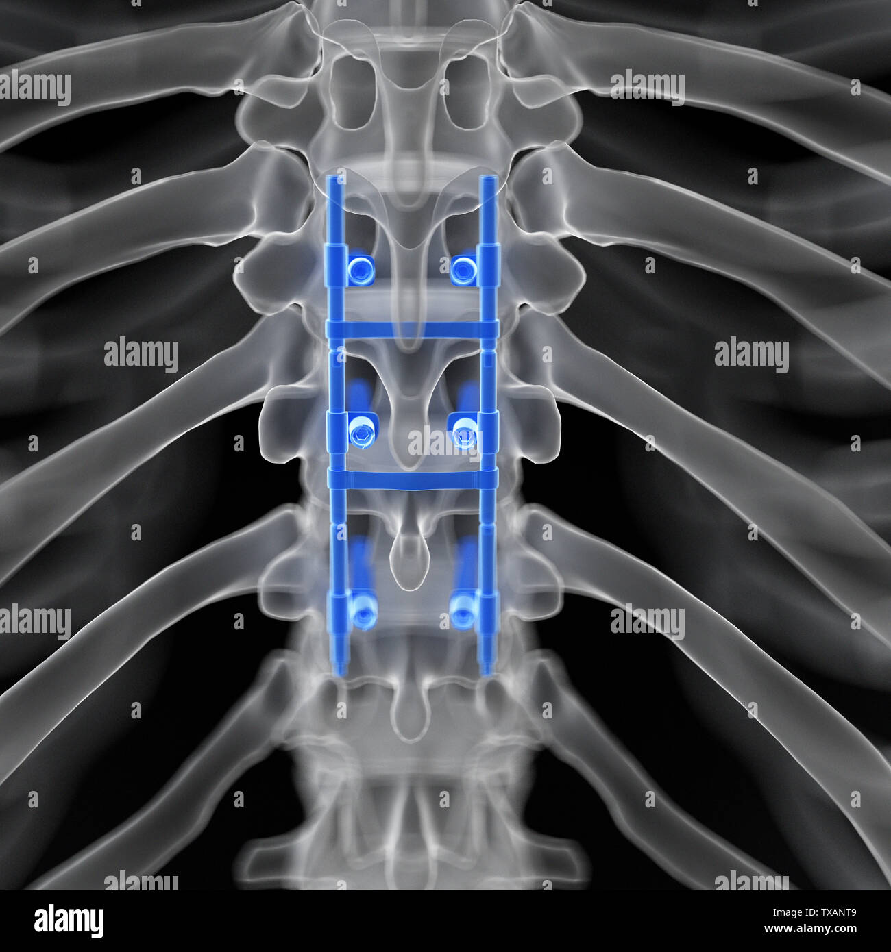 Spinal fusion hi-res stock photography and images - Alamy