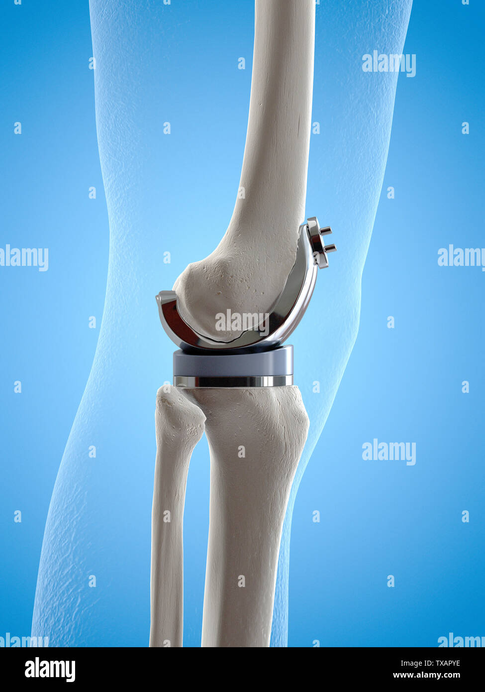3d rendered medically accurate illustration of a knee replacement Stock ...