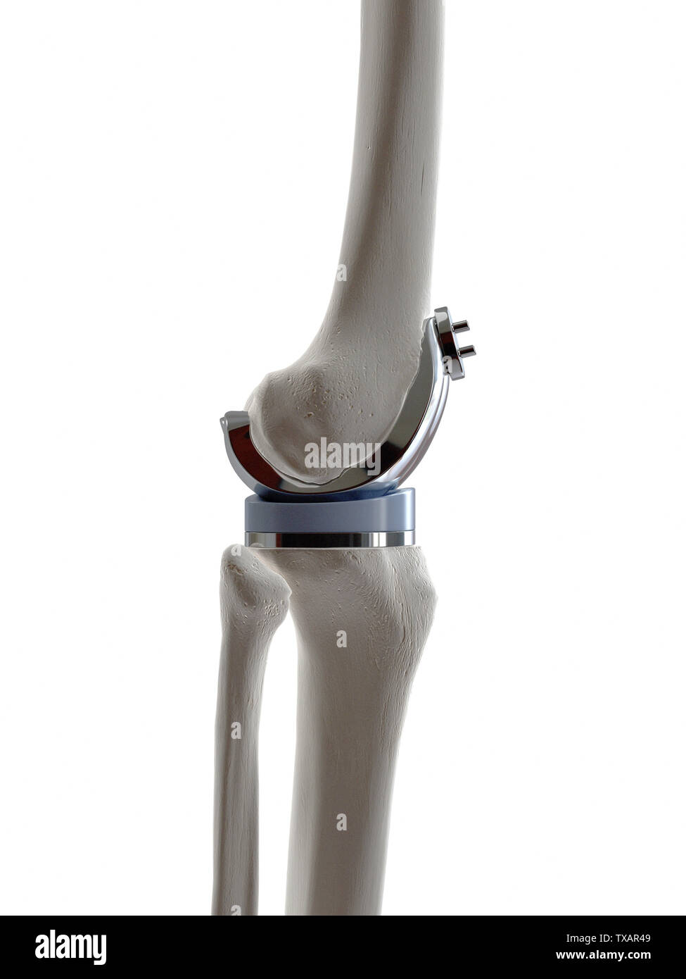 3d rendered medically accurate illustration of a knee replacement Stock ...