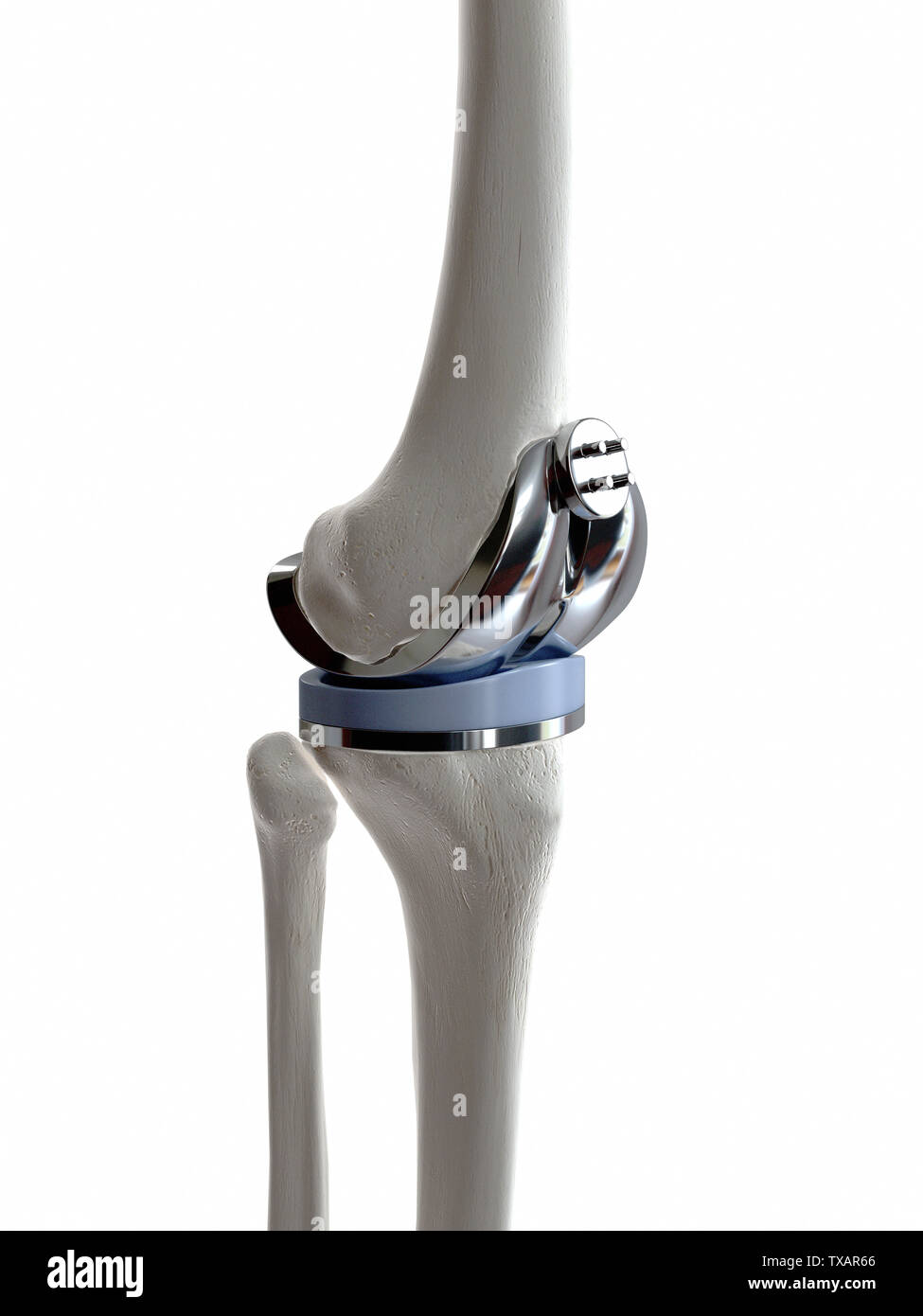 3d rendered medically accurate illustration of a knee replacement Stock ...