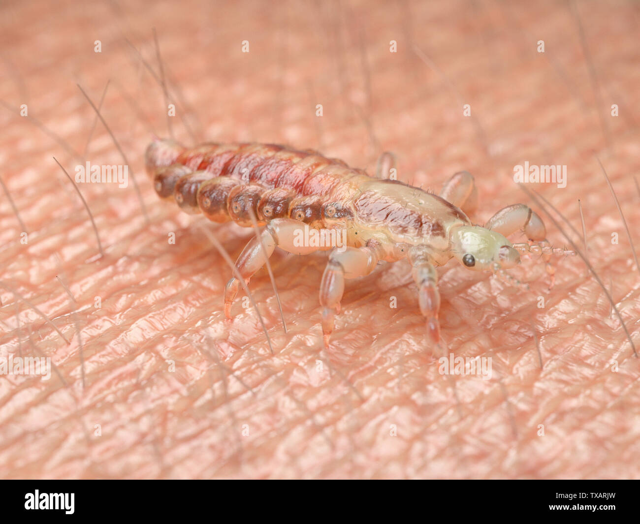 Lice bite hi-res stock photography and images - Alamy
