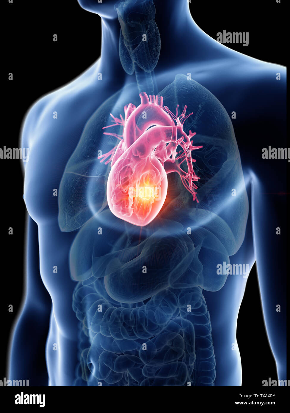 3d rendered medically accurate illustration of a mans heart tumor Stock ...