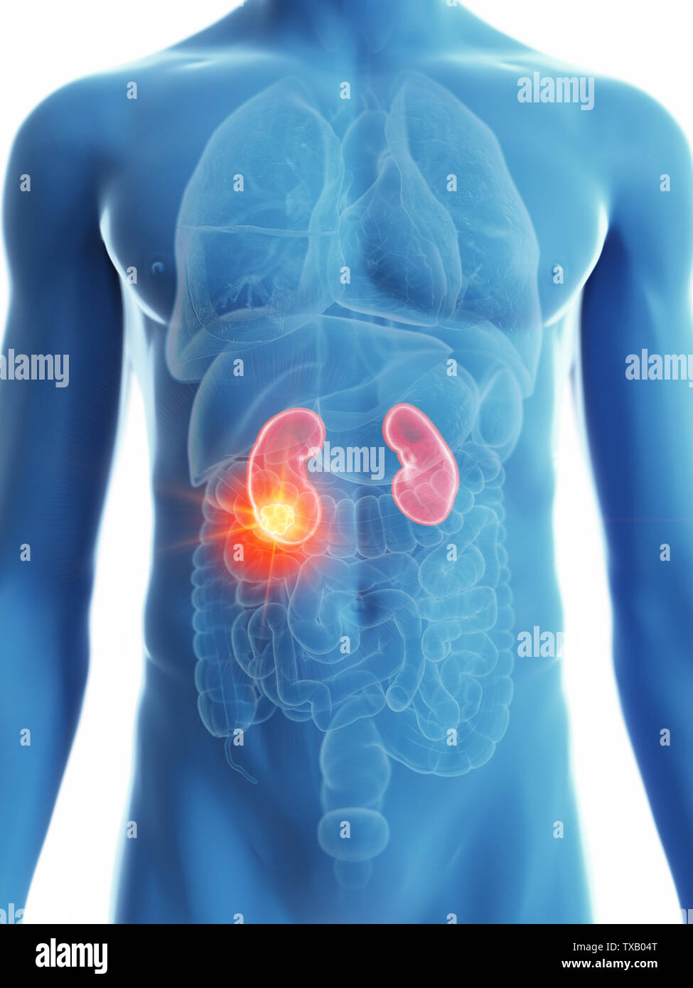 3d rendered medically accurate illustration of a mans kidney cancer ...