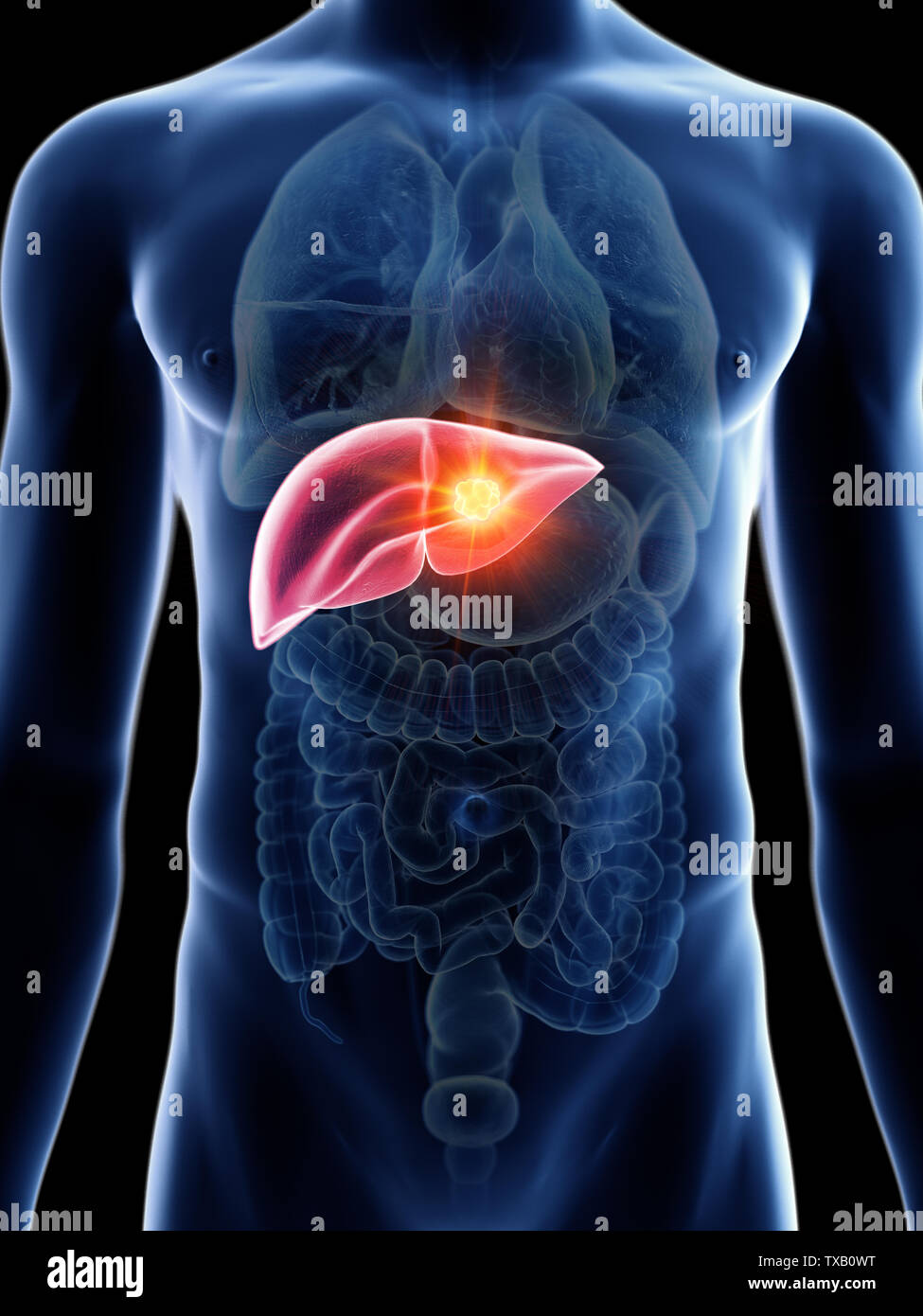 3d rendered medically accurate illustration of a mans liver cancer ...