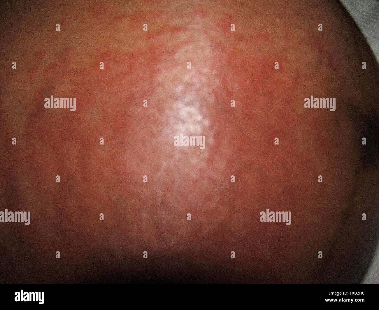 Papules High Resolution Stock Photography and Images - Alamy