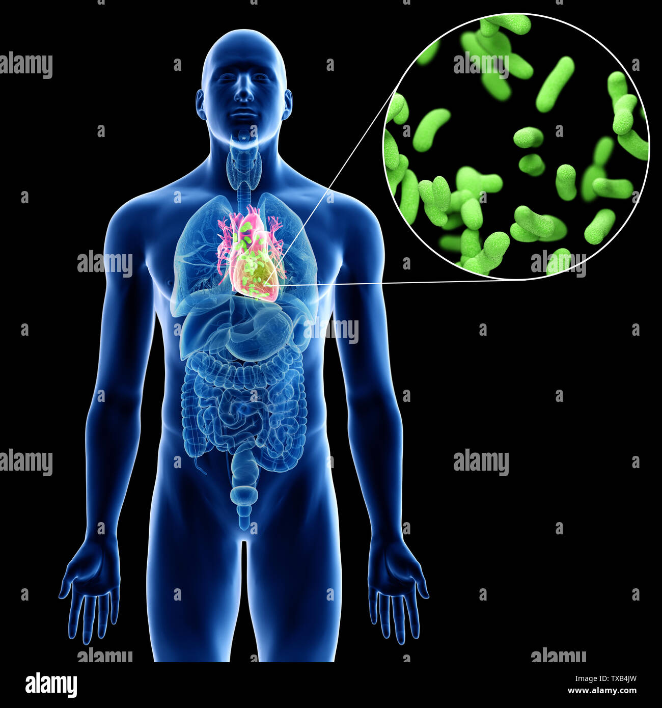 3d rendered medically accurate illustration of a mans heart infection ...
