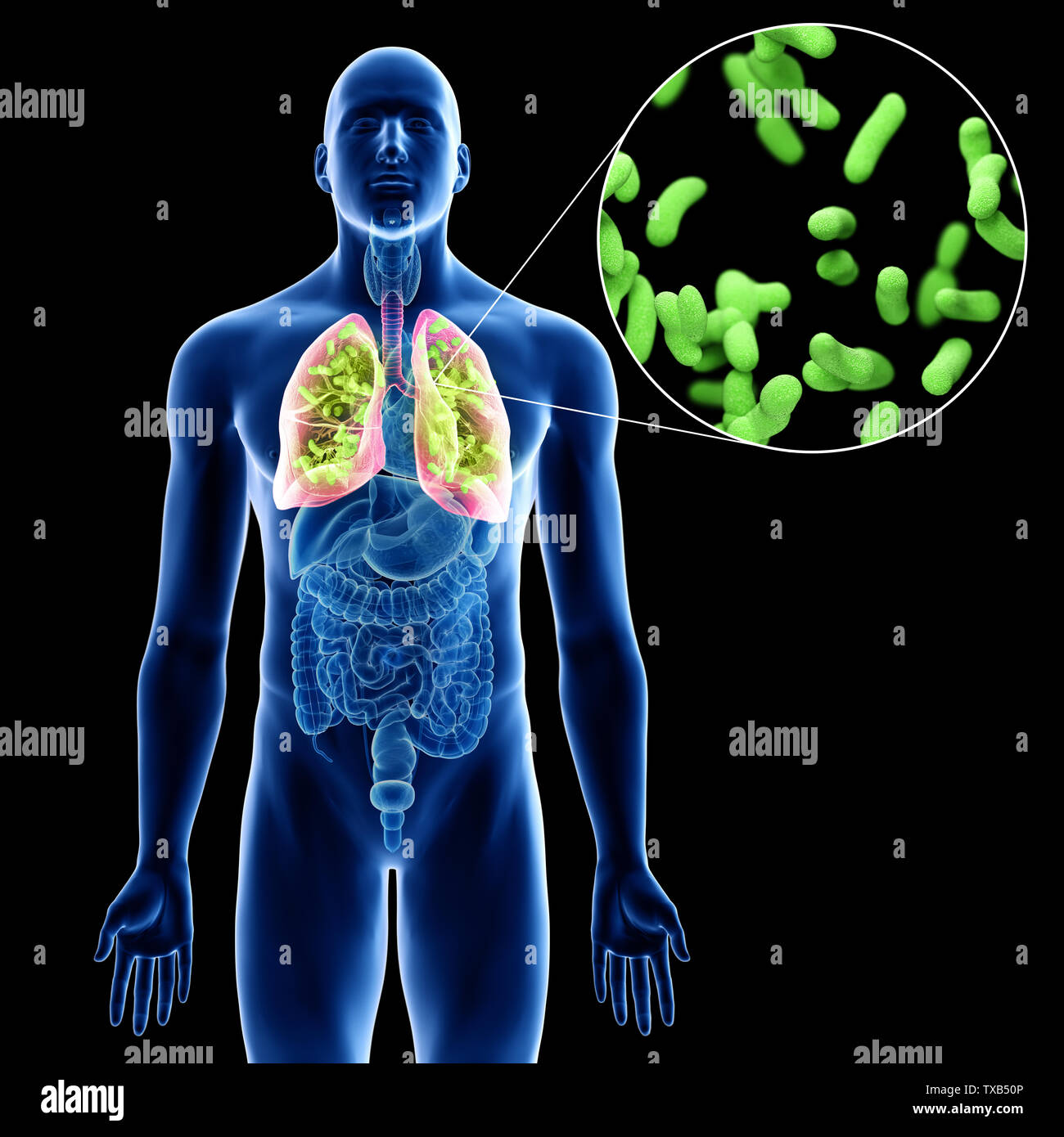 Lung infection hi-res stock photography and images - Alamy