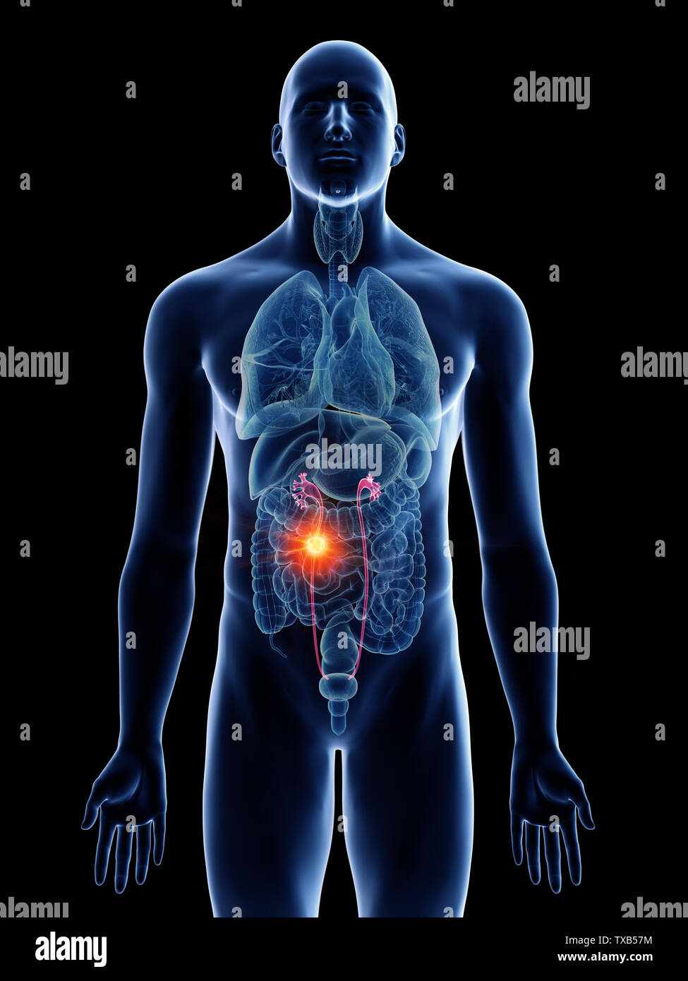 3d rendered medically accurate illustration of a mans ureter cancer ...